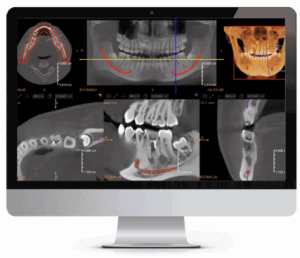What Is CBCT and Why Might Your Dentist Recommend It? – X Dental Imaging